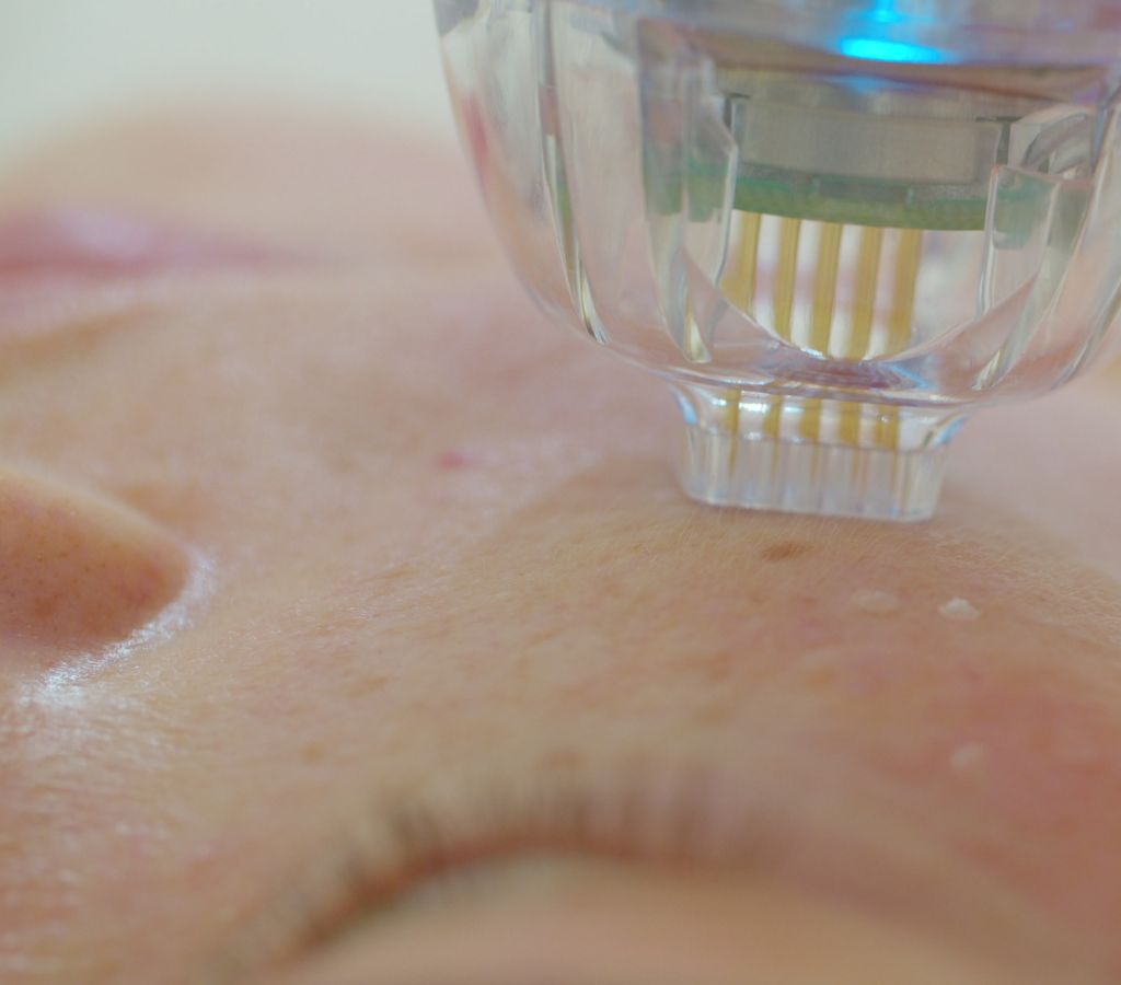 Maximizing Your Microneedling RF Treatment with Velež Intense Hydration ...